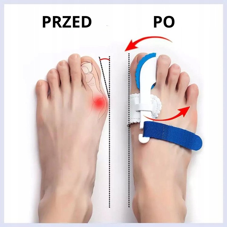 Korektor Na Haluksy Orteza Korekcyjna Na Haluks X2 - Livoyn | Sport ...