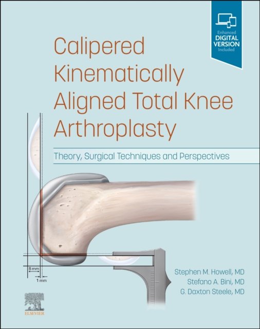 Calipered Kinematically aligned Total Knee Arthroplasty: Theory ...