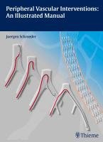 Peripheral Vascular Interventions: An Illustrated Manual - Schroder ...
