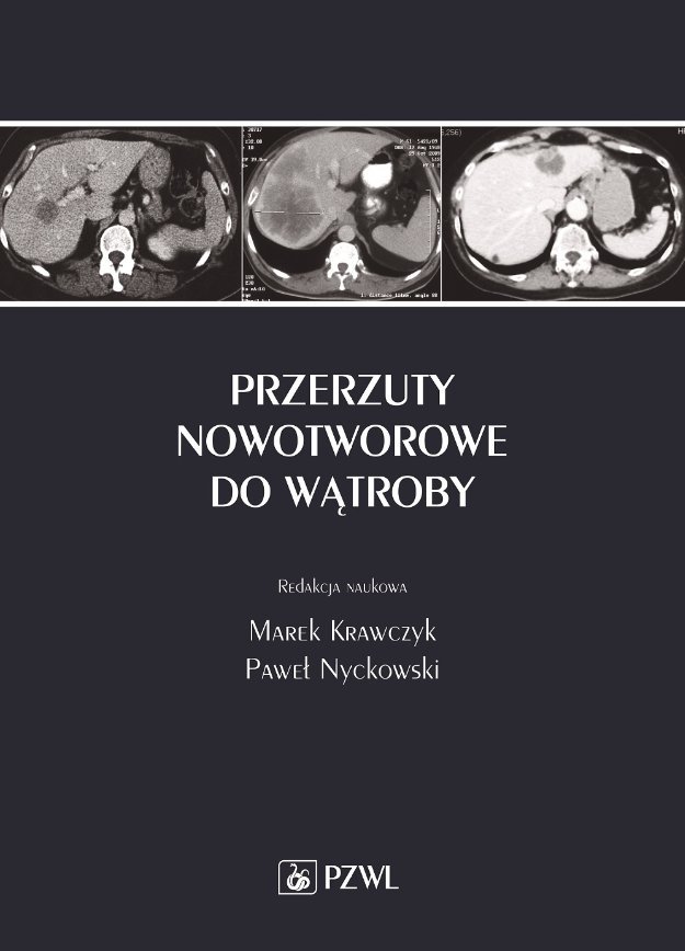 Przerzuty nowotworowe do wątroby - ebook mobi - Krawczyk Marek | Ebook ...